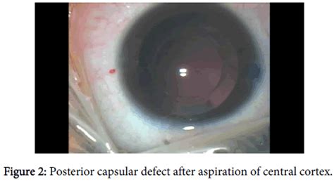 New Sign For Recognizing Posterior Lenticonus Complicated With Ca