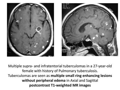 Clinical Radiology Cerebral Tuberculosis Pptx Brain And Nervous