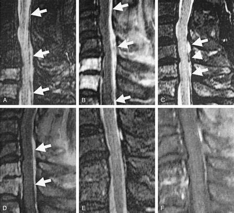 Case 2 A 66 Year Old Man Who Received Epidural Anesthesia And