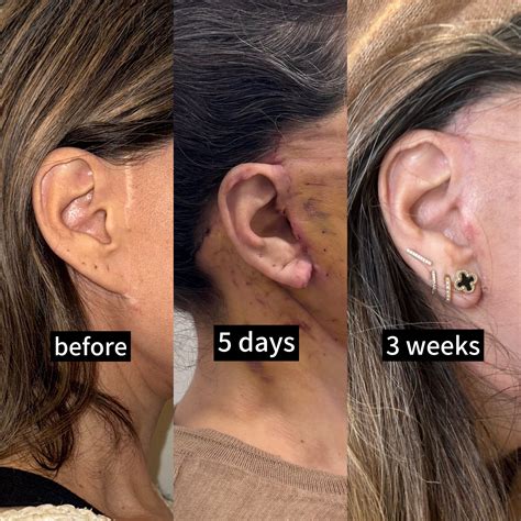 Pixie Ear Deformity After Facelift Prevention And Correction