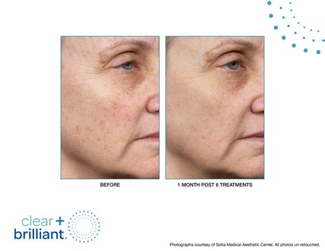 Clear Brilliant Laser Folsom Dermatology Folsom Ca