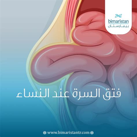 أسباب فتق السرة عند النساء وطريقة علاجه بيمارستان