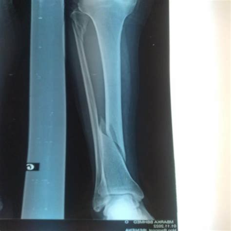 Bone Fracture Classification Object Detection Model By Bone Fracture