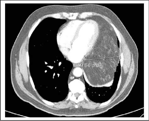 Figure 1 From Thymolipoma With Sebaceous Differentiation Semantic Scholar