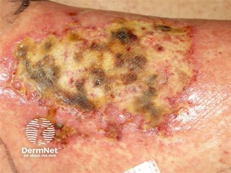Retiform Purpura