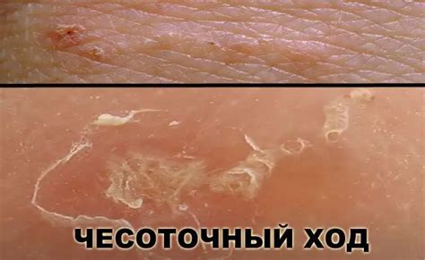 Scabies Types Symptoms Causes And Treatment Healthy Food Near Me