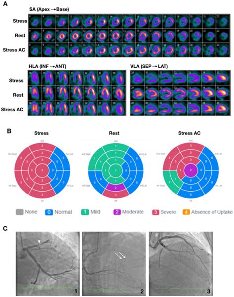 Ischemia Myocardial Perfusion
