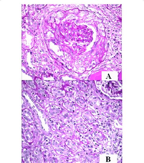 A Sampling For Light Microscopy Reveals A Focal Segmental Necrotizing