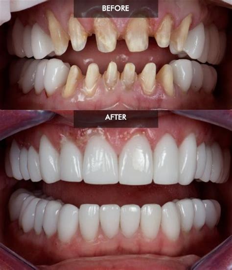 Zirconia Crown Before And After Zirconia Crown Turkey How Is It