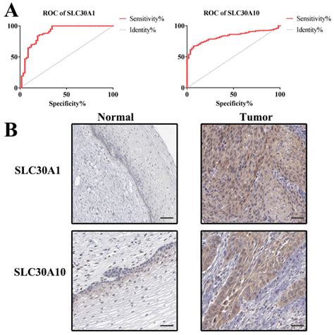 The Correlation And Role Analysis Of Slc30a1 And Slc30a10 In Cervical