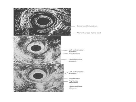Perianal Suppuration Abscess And Fistula Ppt Video Online Download