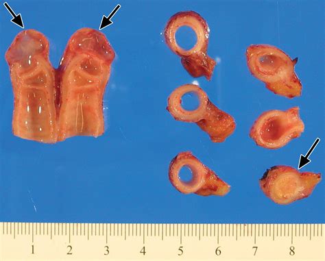 Neoplasms Of The Appendix Pictorial Review With Clinical And