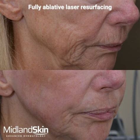 Fully Ablative Co2 Laser Resurfacing Dermatologists Birmingham