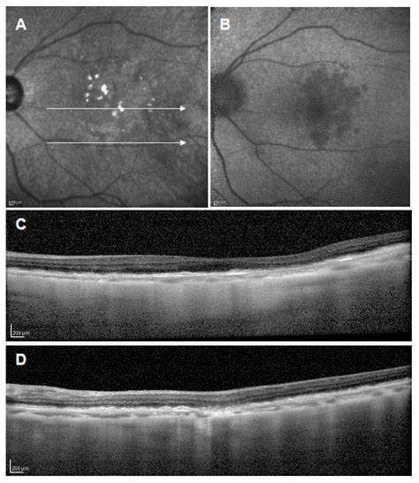 Jcm Free Full Text Early Stages Of Age Related Macular Degeneration