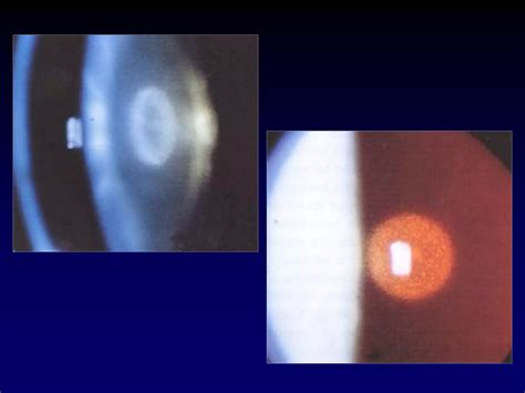 H2 Congenital And Developmental Cataractppt