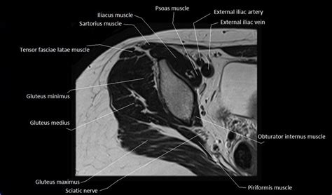 Mri Anatomy Of Hip Joint Free Mri Axial Hip Anatomy