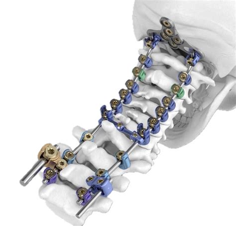 Product Detail Neurospine
