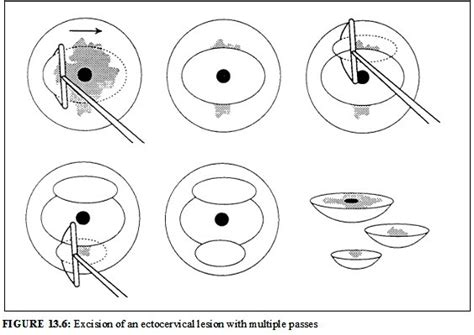 Colposcopy And Treatment Of Cervical Intraepithelial Neoplasia A