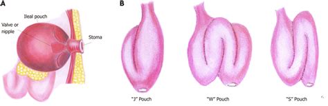 Internal J Pouch