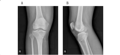 The Postoperative X Ray Showed An Endobutton Plate Smith And Nephew