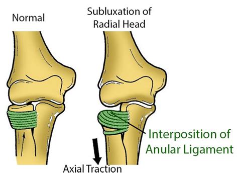 Nursemaids Elbow Pediatrics Orthobullets