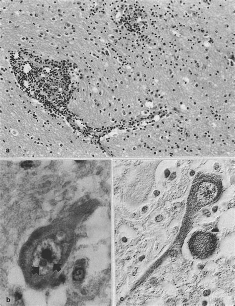 A Perivascular Cuffs And Diffuse Lymphocytic Infiltration Of Adjacent Download Scientific