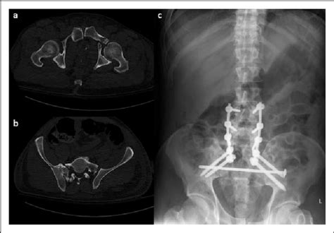 Sacral Fracture With M3 Modifier A Axial Ct Shows Anterior Pelvic Download Scientific