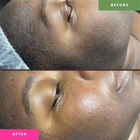 Microdermabrasion On Dark Skin Before And After