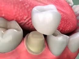 Cap Crown What S The Difference Cygnet Dental