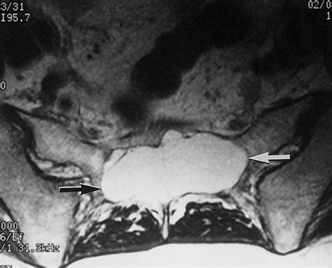 Case 47 Dural Ectasia Associated With Marfan Syndromeradiology