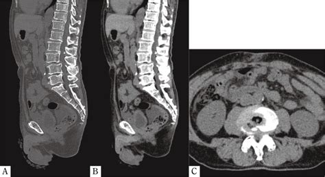 A Ct Sagittal Bone Window Setting B Ct Sagittal Soft Tissue