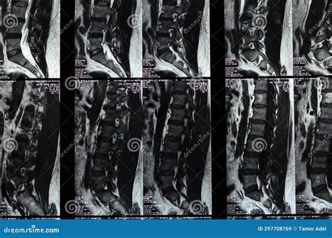 Cairo Egypt November 14 2023 Mri Of Lumbosacral Spine Revealed
