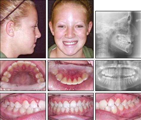 Early Treatment Of Skeletal Class Iii Open Bite With The Tandem
