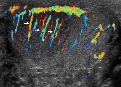 Contrast Enhanced Ultrasound In The Evaluation Of Focal Testicular Complications Secondary To