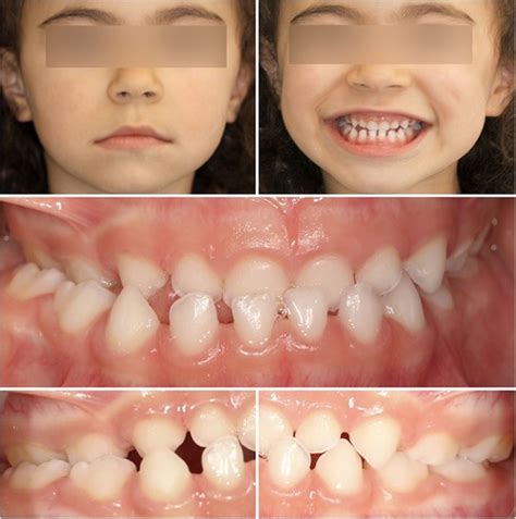 Frontiers A New Challenge For Crossbite Treatment
