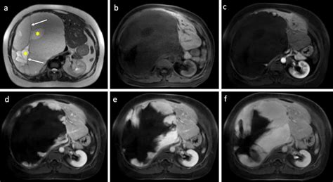 Giant Hemangioma Mr Imaging Shows A Giant Hh Appearing As A