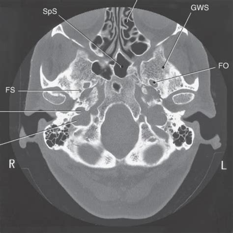 Sphenoid Bone Axial Ct Diagram Quizlet