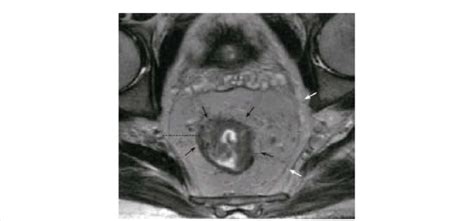 Mri Of Rectal Cancer With Demonstration Of Circumferential Resection Download Scientific