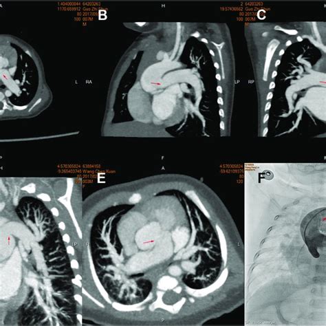 Pre Operative Computed Tomography Ct Angiography And Cardiac