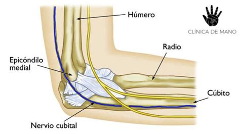 Sindrome Del Túnel Epitrocleo Olecraneano Clínica De Mano
