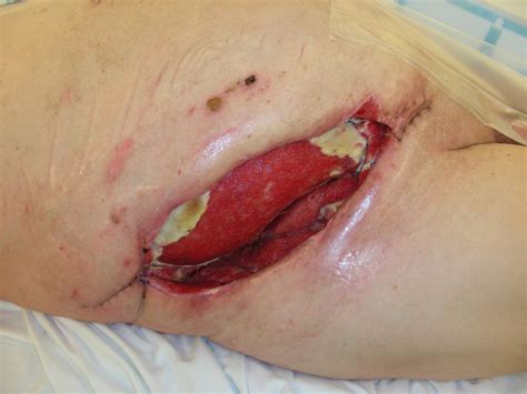 Hip Reconstruction Plastic Surgery Key