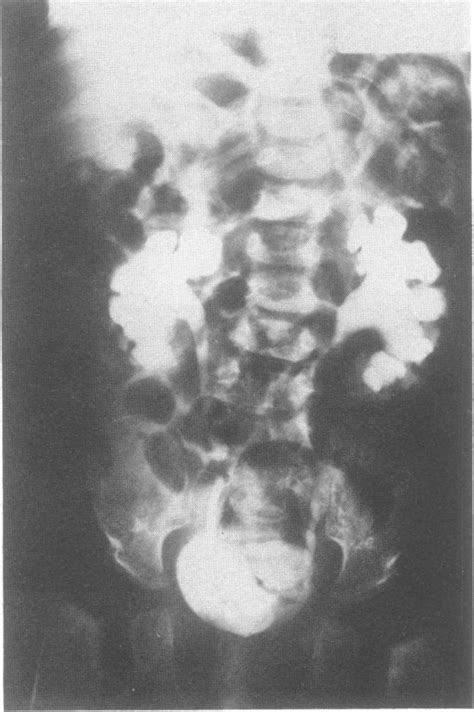 Hydronephrosis X Ray