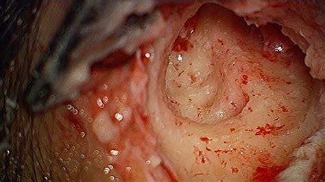 Ear Surgery Earaidnepal