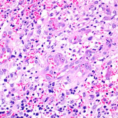 Cytomegalovirus Immunohistochemical Stain The Infected Cells With Cmv