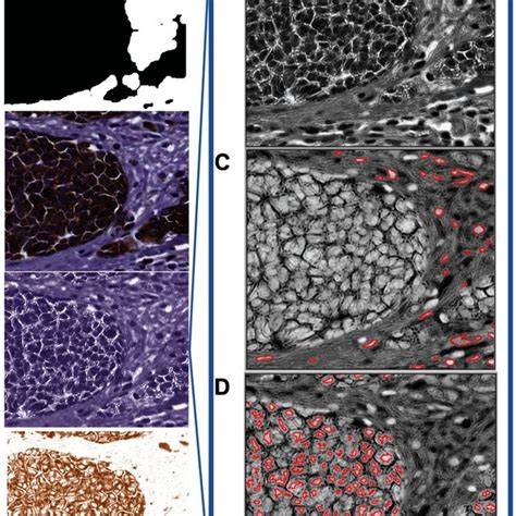 Cell Nuclei Segmentation Of Melan A Stained Tmas Tissue Spot Images
