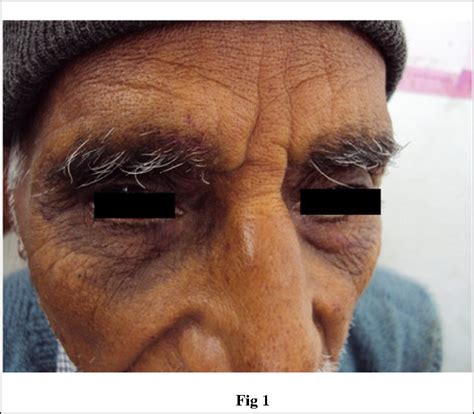 Figure 1 From Primary Systemic Amyloidosis And The Dermatologist