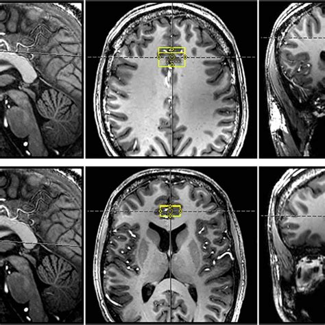 Representative Voxel Position In A Dorsal Anterior Cingulate Cortex Download Scientific