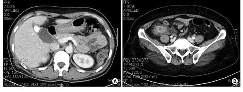 Figure 1 From Single Incision Laparoscopic Surgery For Simultaneous Appendectomy And