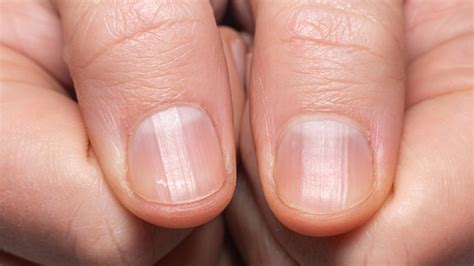 Cómo Tus Uñas Te Advierten Sobre Tu Salud Y Ayudan A Detectar Enfermedades