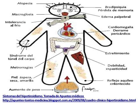 Hipotiroidismo